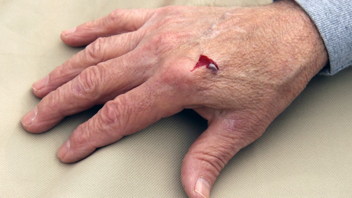 Laceration Treatment in Flushing, NY | Urgent Care Clinic